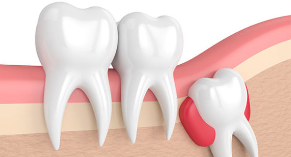 Les chirurgies des kystes des maxillaires - Stomatologue Paris 15